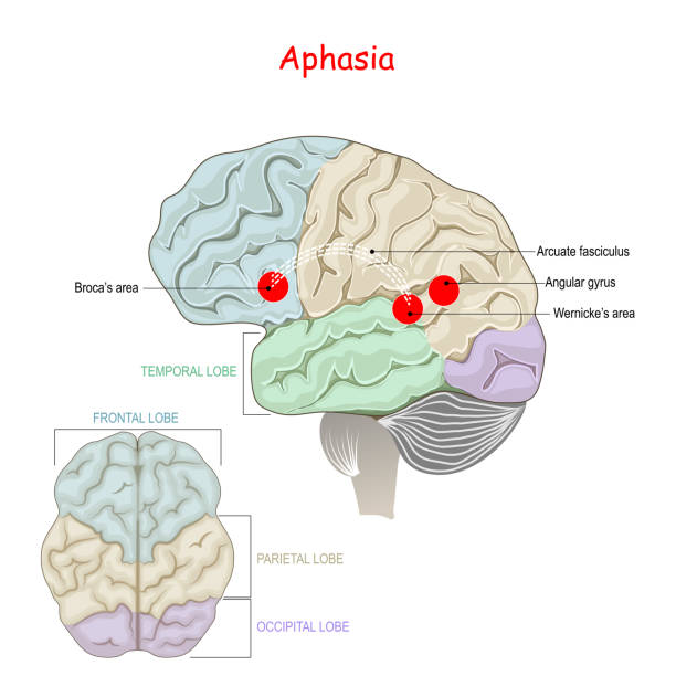 What Is Aphasia Causes Birla Hospital What Is Aphasia Causes Birla Hospital