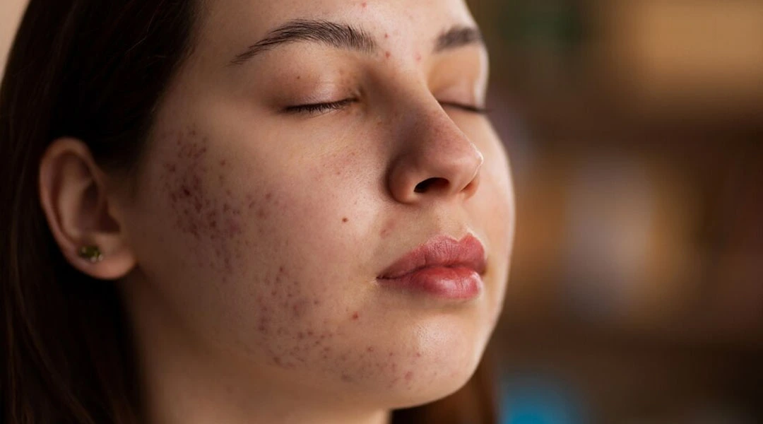 How To Get Rid Of Dark Spots Sujata Birla Hospital How To Get Rid Of Dark Spots Sujata Birla Hospital